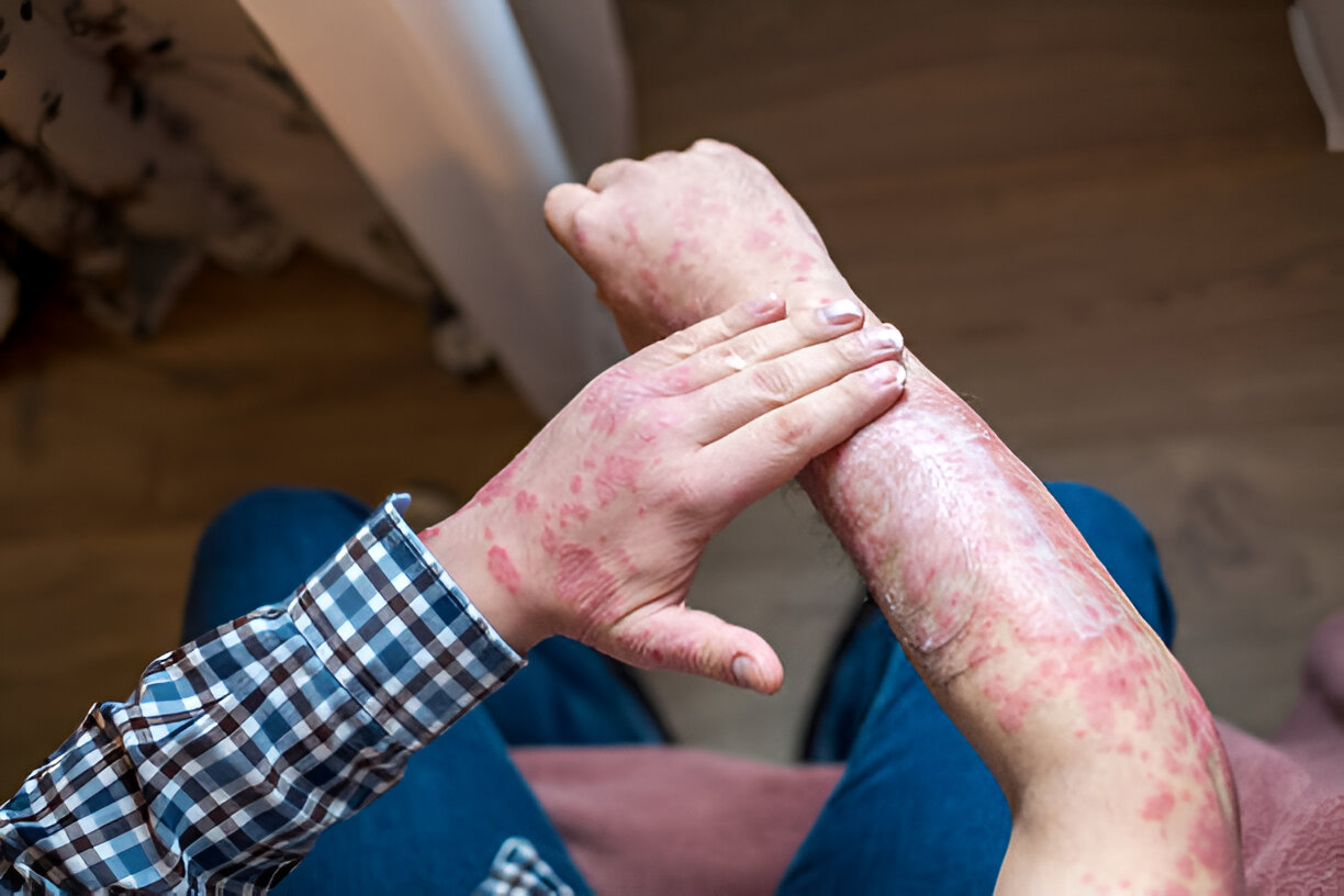 Psoriazė: simptomai, tipai ir gydymas - SveikaAkis.lt