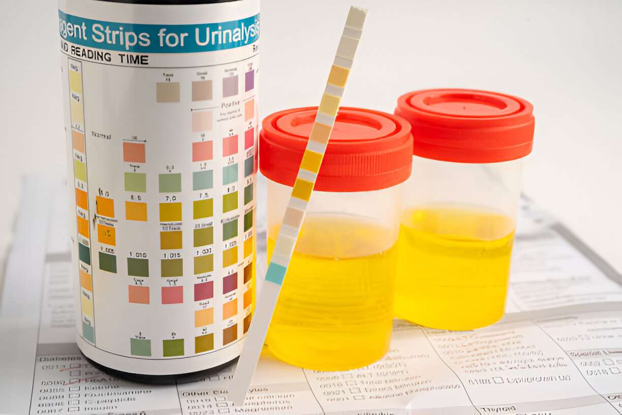 Šlapimo spalvos pokyčiai: ką rodo ir kada sunerimti - SveikaAkis.lt