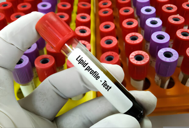 Lipidų profilis: kodėl svarbu tirti cholesterolio lygius - SveikaAkis.lt