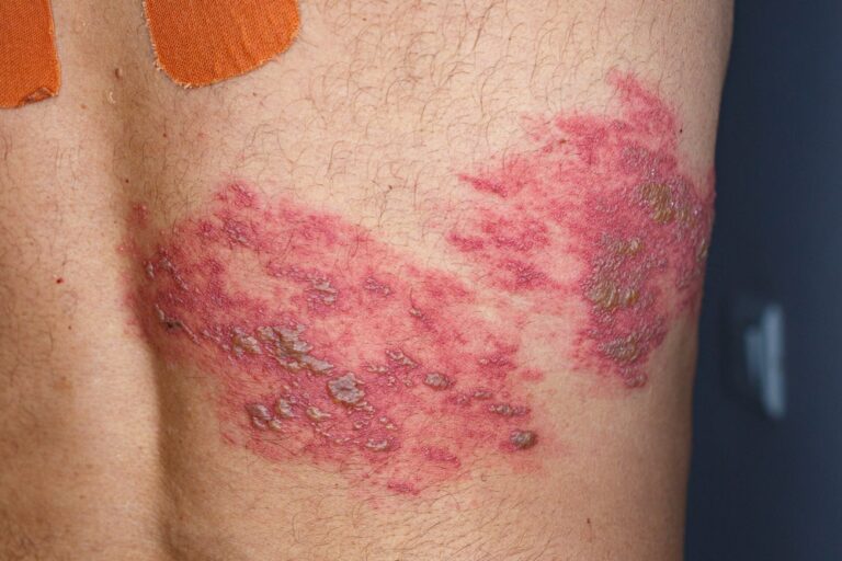 ŽPV (žmogaus papilomos virusas): priežastys, simptomai ir gydymas ...